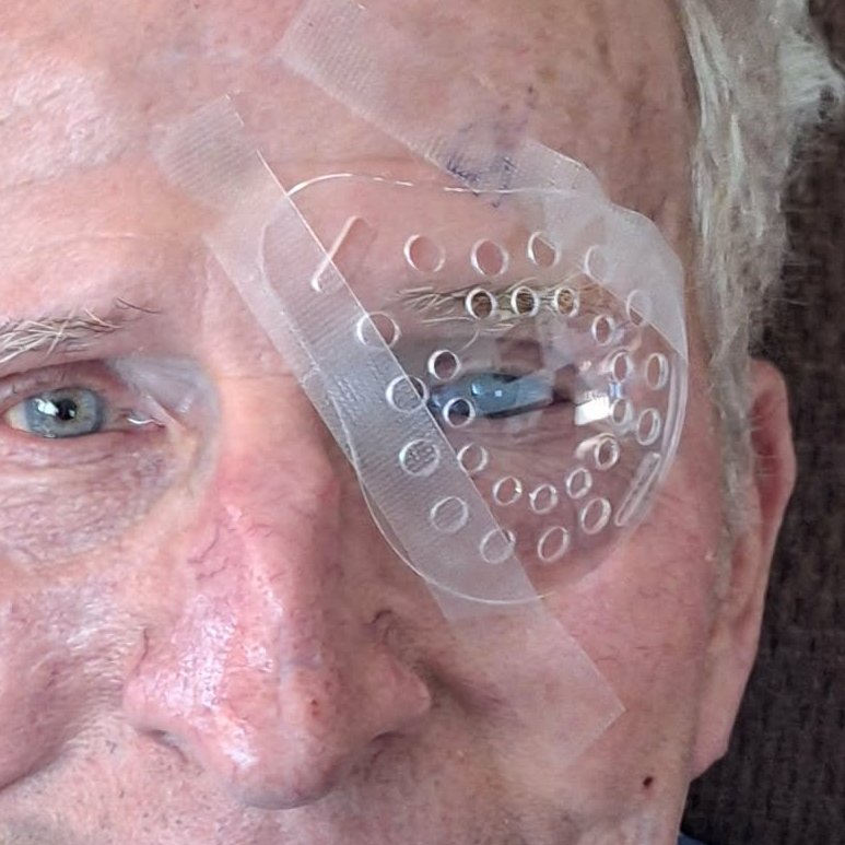 Cerwin’s First Cataract Surgery was Successful – My Journey – by Doris High